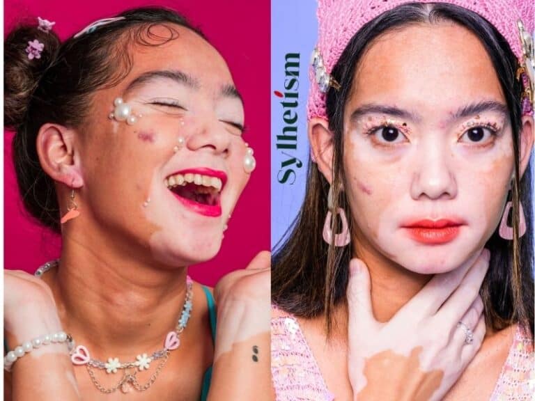 শ্বেতী রোগ থেকে মুক্তির উপায়, শ্বেতী রোগের খাবার । ২০২৪ - Sylhetism